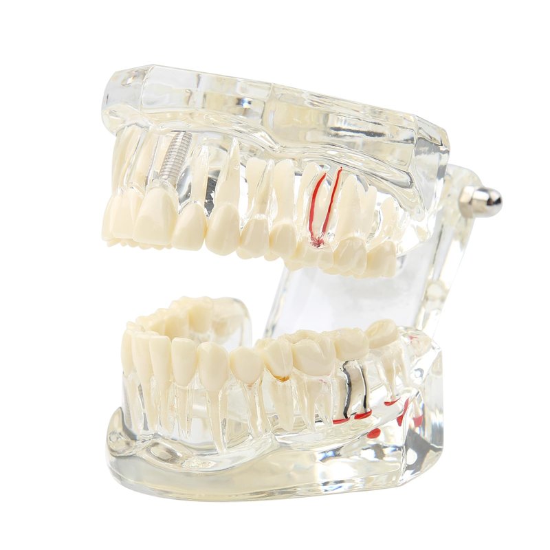 Dental Transparent Disease Teeth Model lmplant Teeth Model Analysis ...