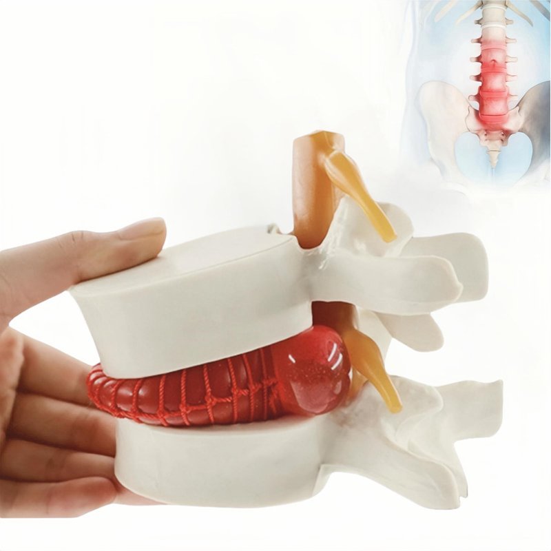 Human Anatomical Lumbar Disc Herniation Model 1.5 Times Life Size ...